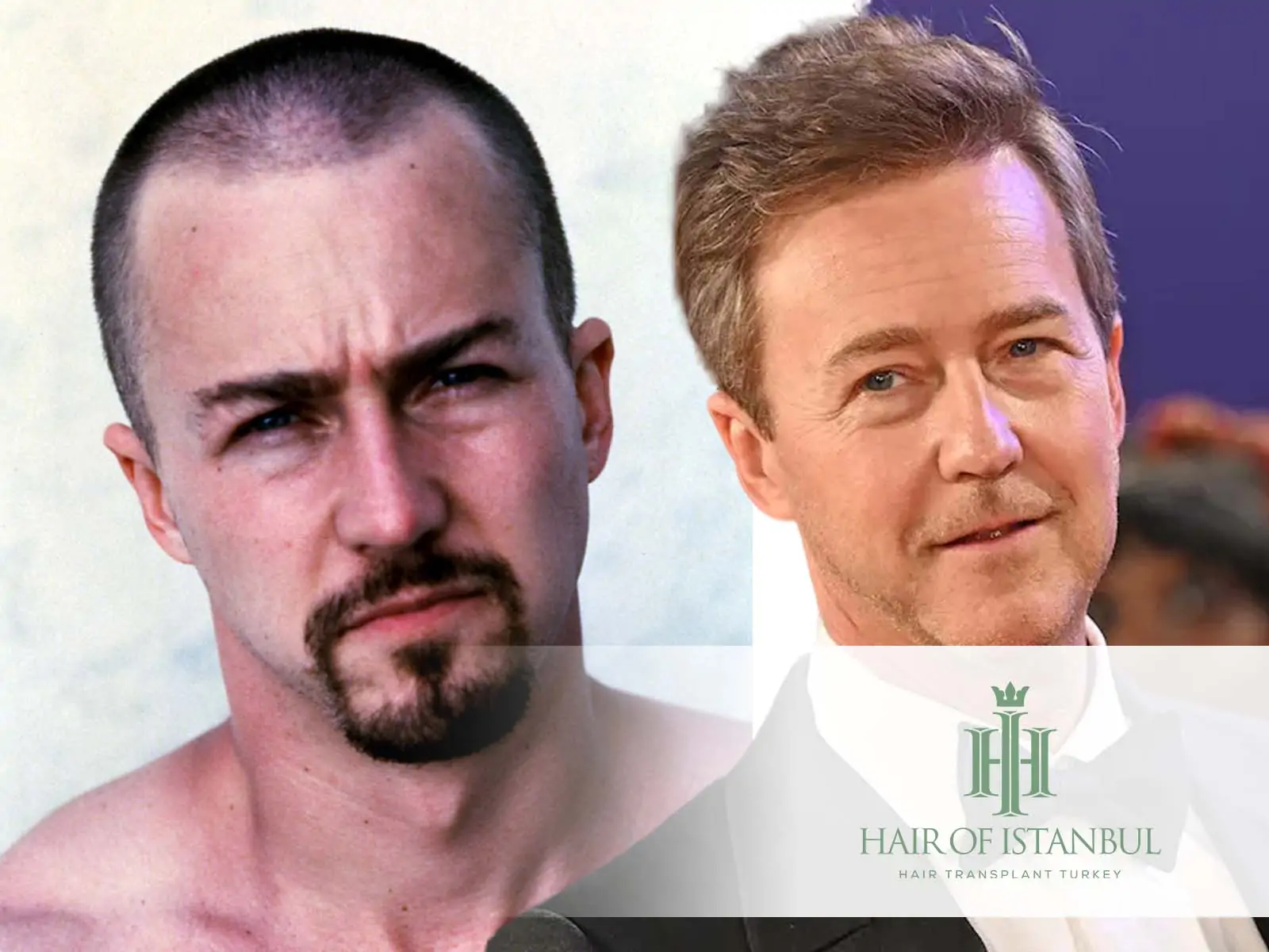 Edward Norton Hair Transplant: Scalp Saga Exposed!