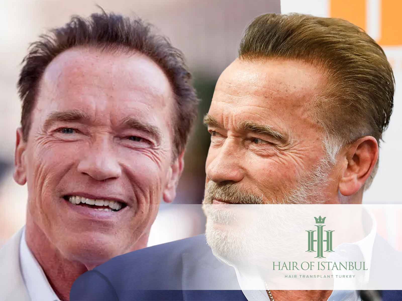 Arnold Schwarzenegger Hair Transplant: Fact Behind The Buzz!