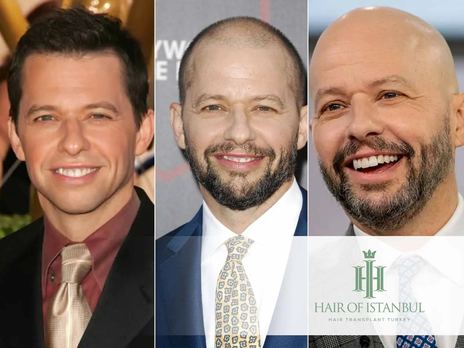 Jon Cryer's Candid Hair Loss Story: From Hair to Bald