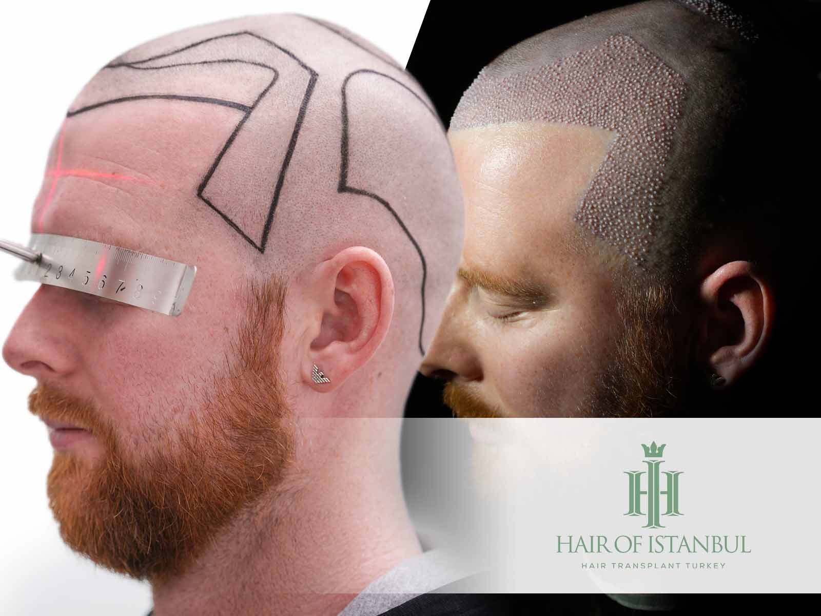 Turkish Hairlines: From No Hairline to Istanbul's Fine Line