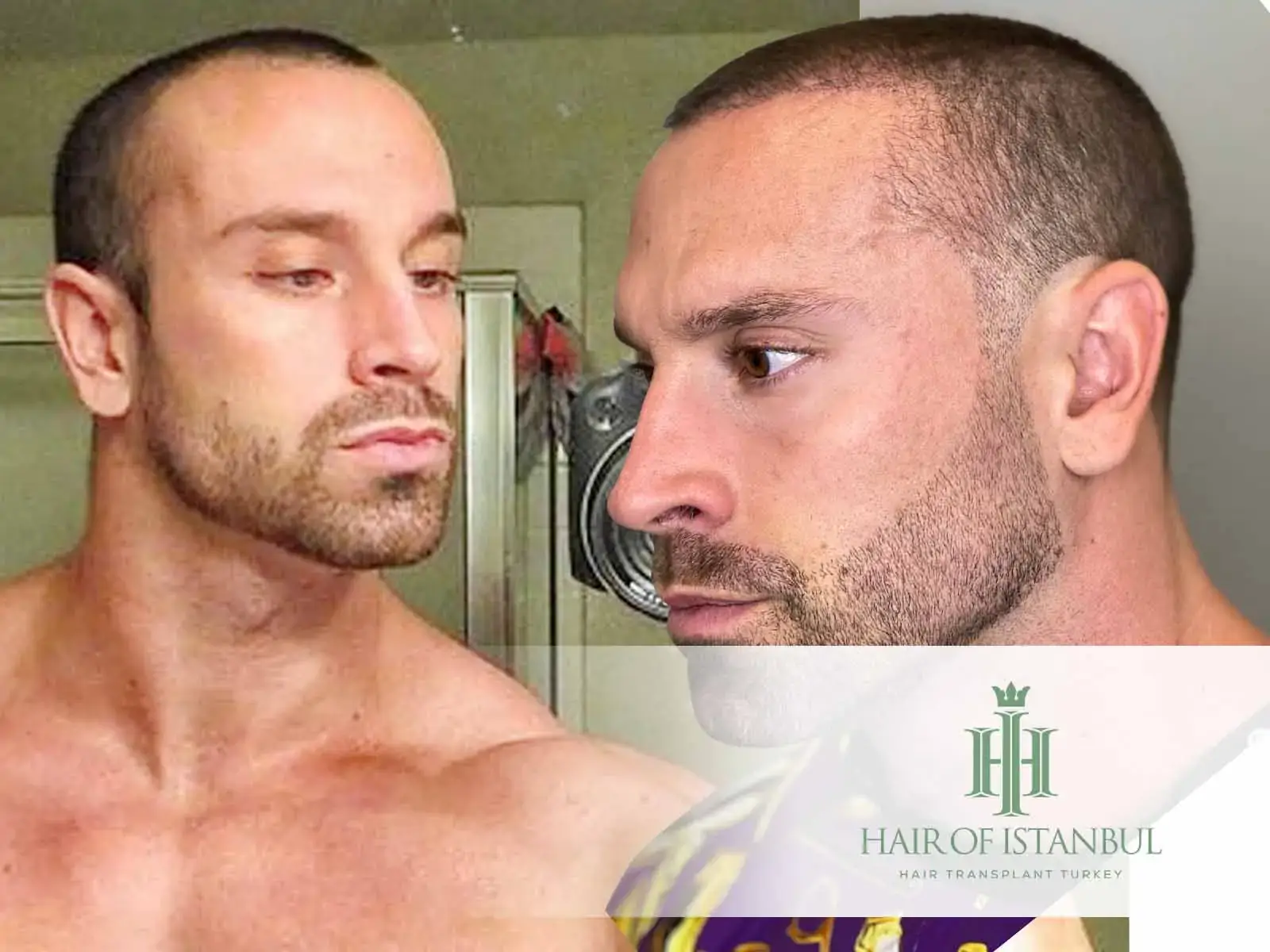Bradley Martyn Hair Transplant: Unveiling the New Look!