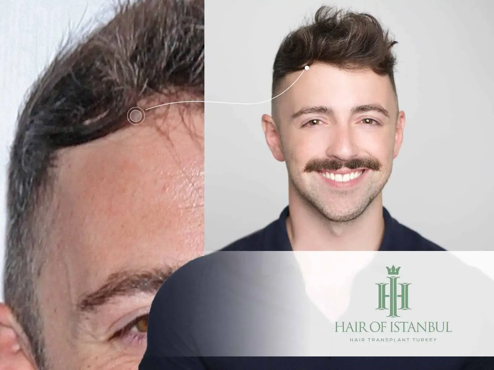 Matteo Lane Hair Transplant: Exclusive Details Revealed