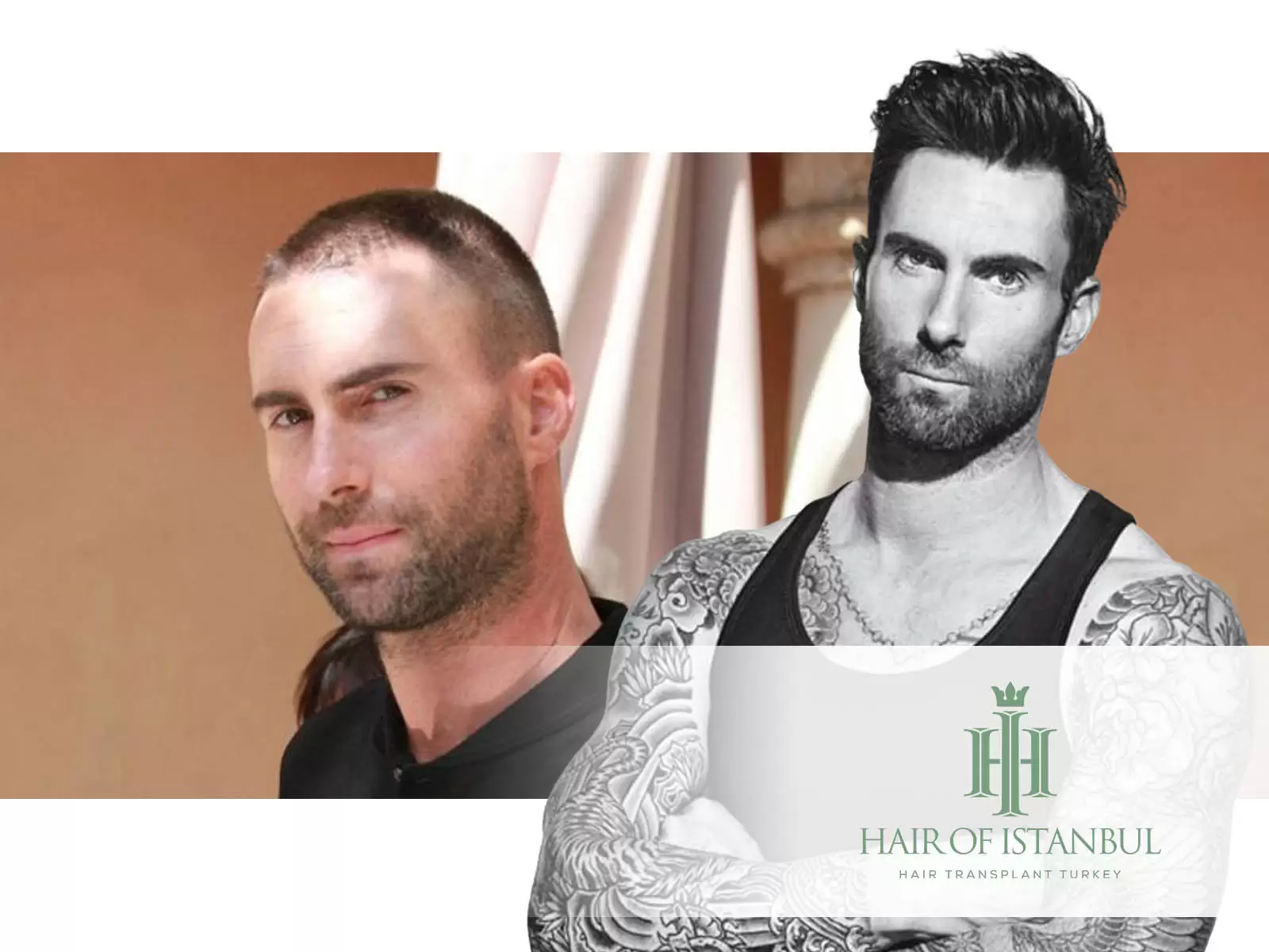 Adam Levine Hair Transplant: Did He Defeat the Bald Look?