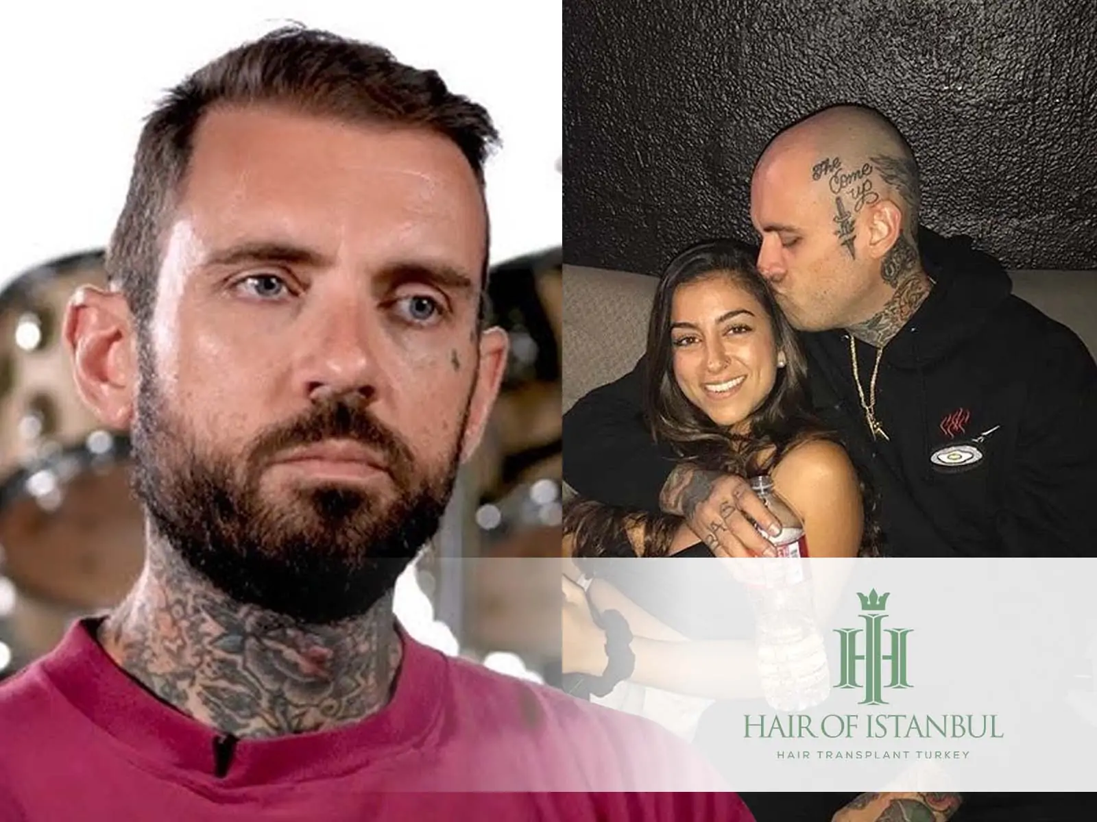Adam22 Hair Transplant: A Deep Dive into His Transformation