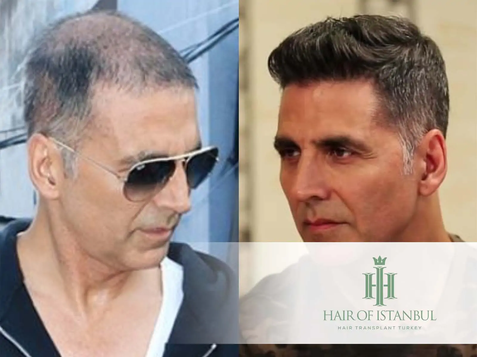 Akshay Kumar Hair Transplant: The Full Scoop on His New Look