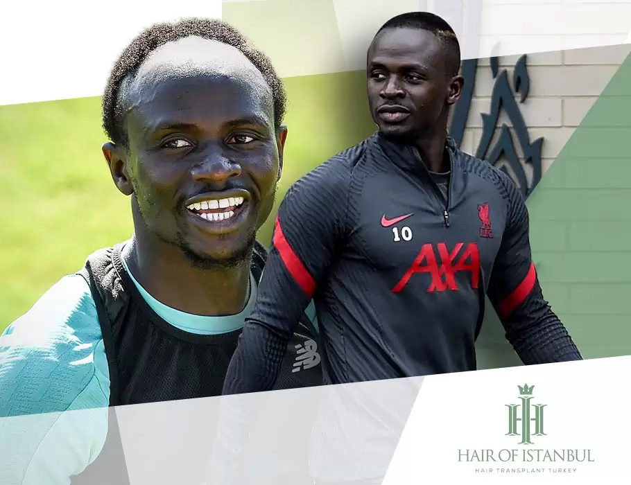 Sadio Mane Hair Transplant: A Closer Look His New Hairline