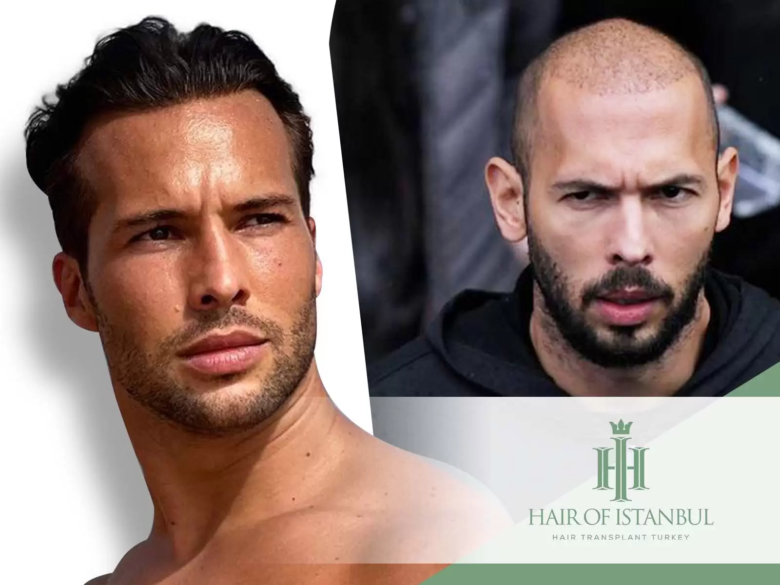 Tristan Tate Hair Transplant: Surprise Announcement Details