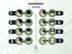 Liam Neeson Hair Transplant: The Real Story