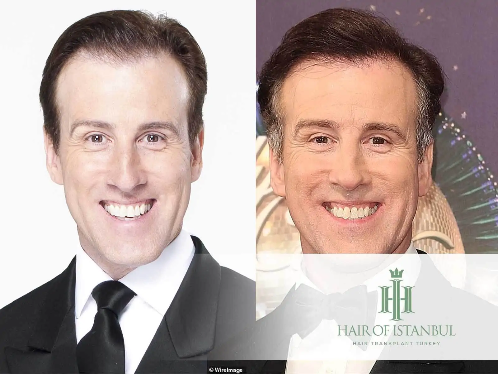 Anton Du Beke Hair Transplant: How It Made Him Feel 25 Again