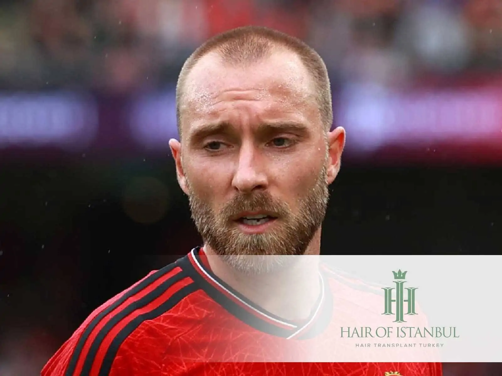 Turkish Hairlines: From No Hairline to Istanbul's Fine Line