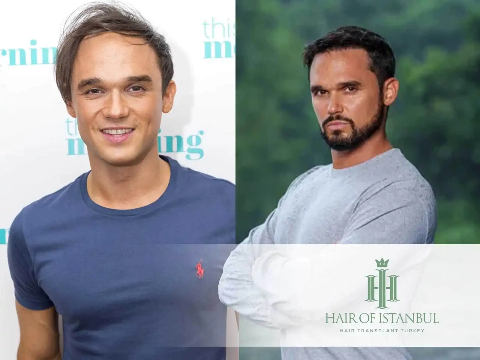 Gareth Gates Hair Transplant: 8 Hours to Transform His Hairline