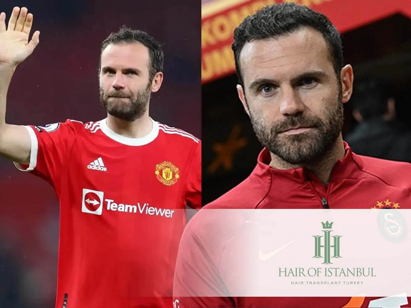 Mo Salah Hair Transplant: Examining the Shift in His Hairline