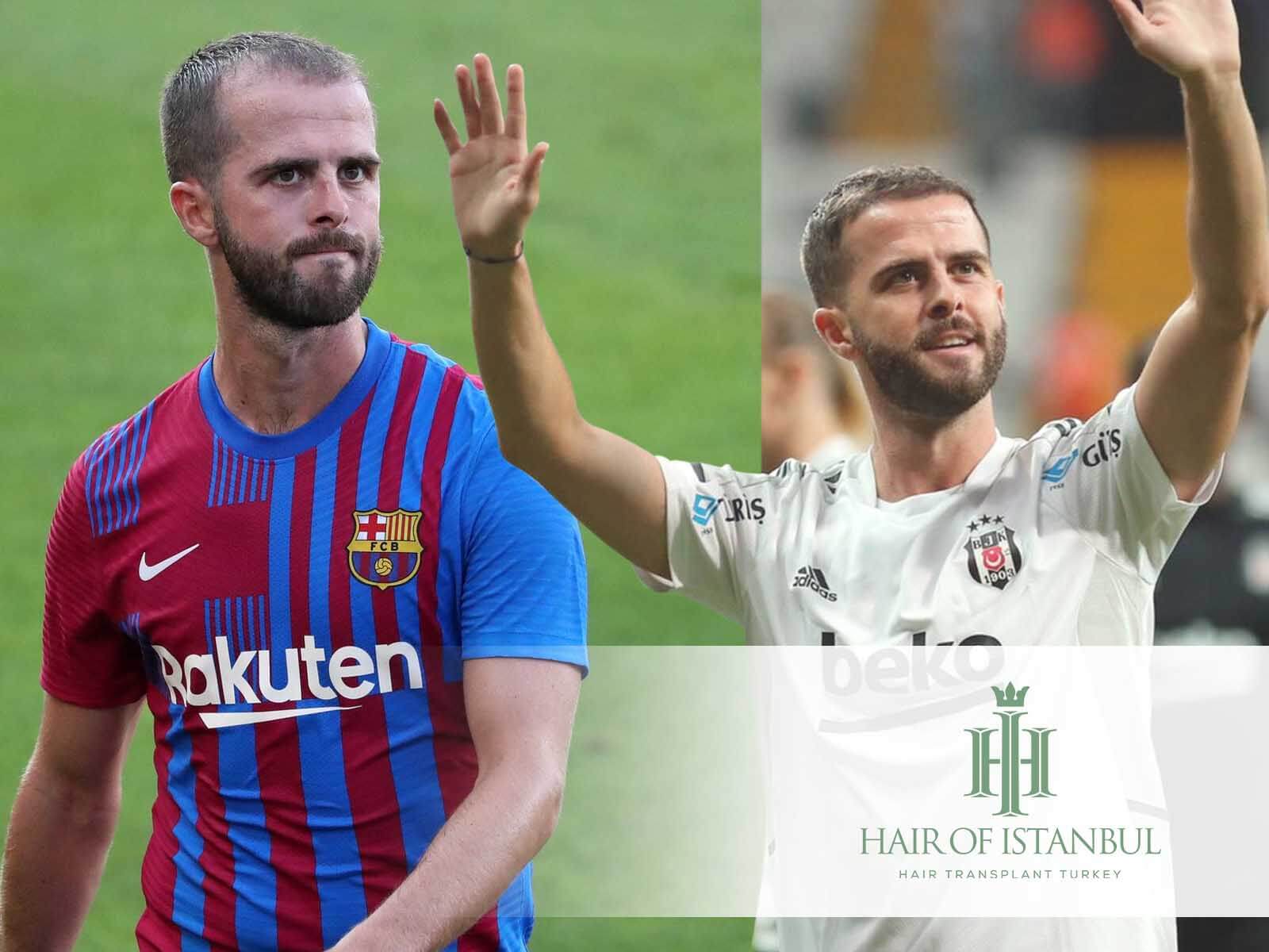 Turkish Hairlines: From No Hairline to Istanbul's Fine Line