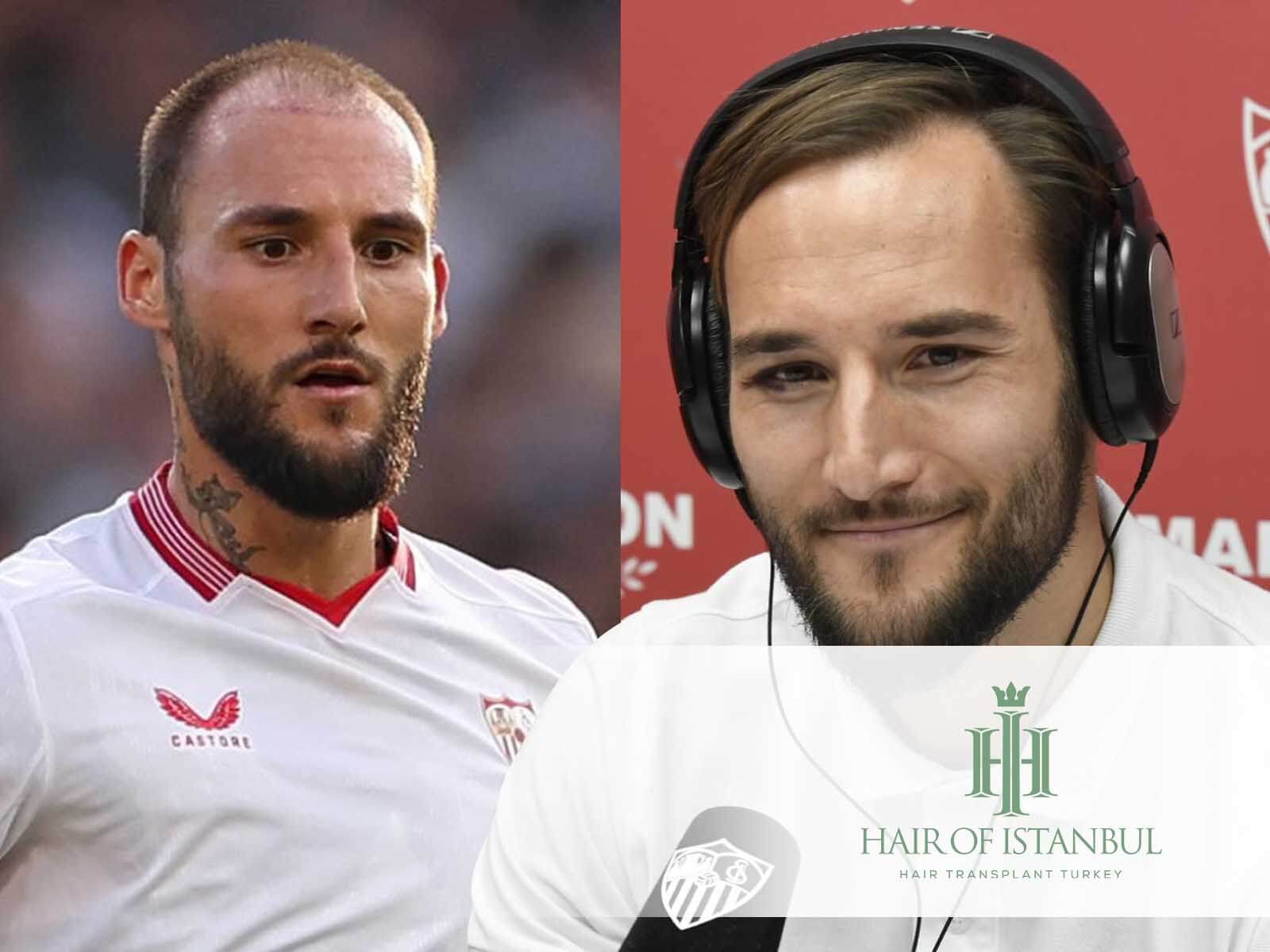Turkish Hairlines: From No Hairline to Istanbul's Fine Line