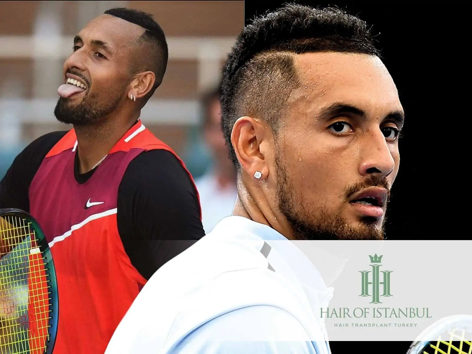Turkish Hairlines: From No Hairline to Istanbul's Fine Line