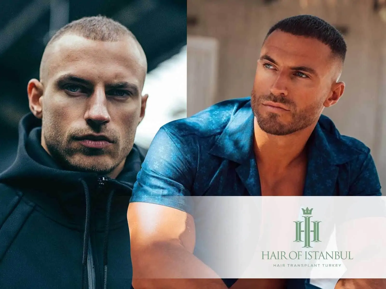 Turkish Hairlines: From No Hairline to Istanbul's Fine Line